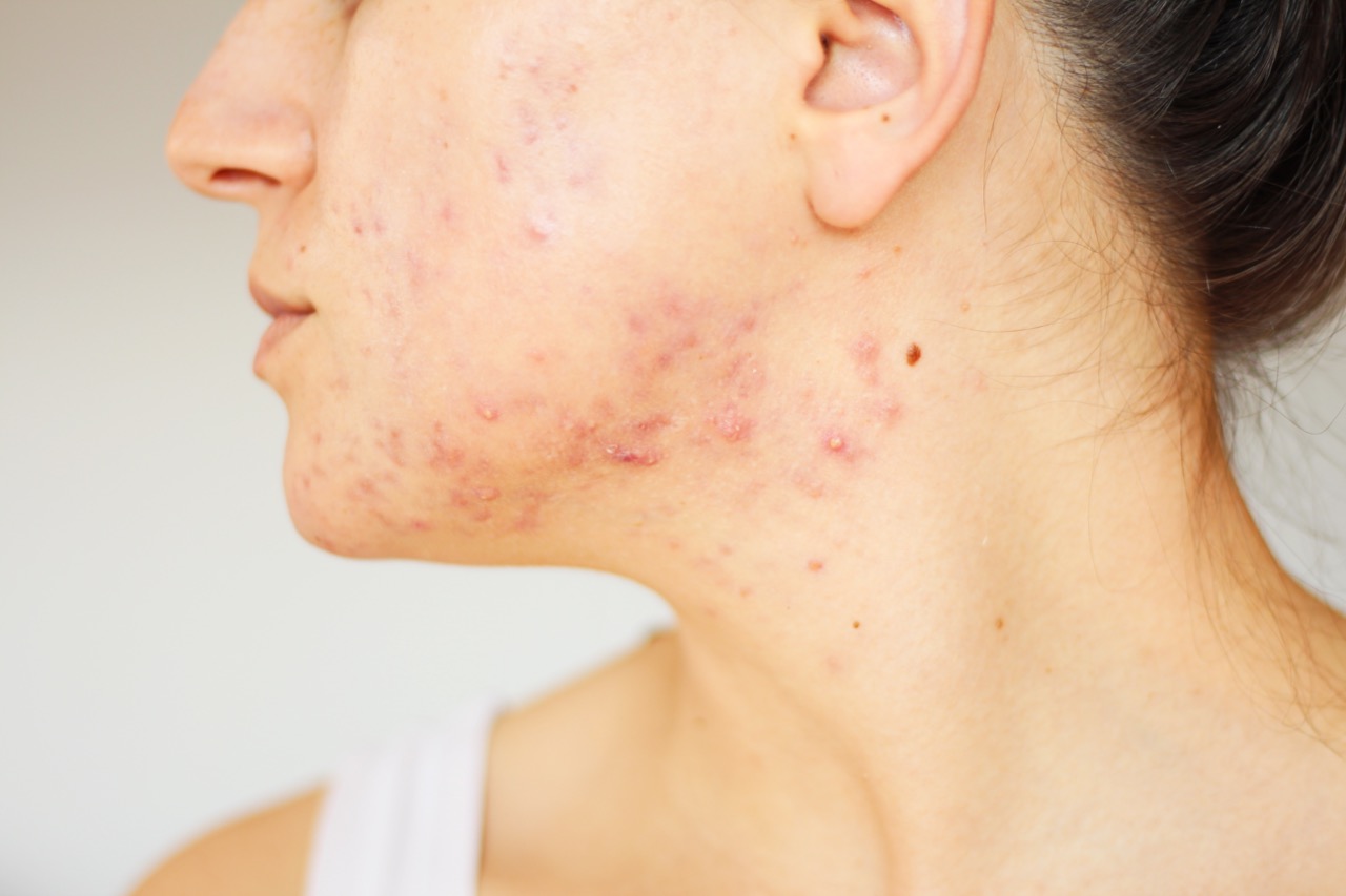 Ups and Downs of Accutane - Northwest Dermatology